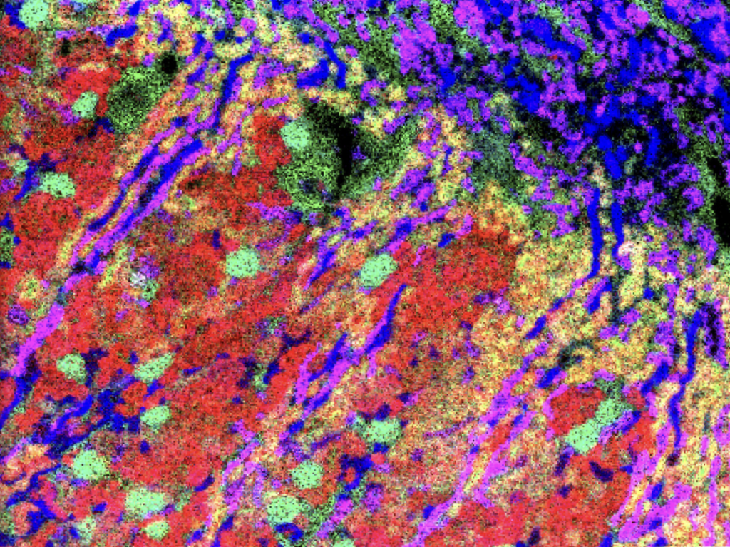 Kidney atlas maps molecular landscape, unlocking clues to renal health ...