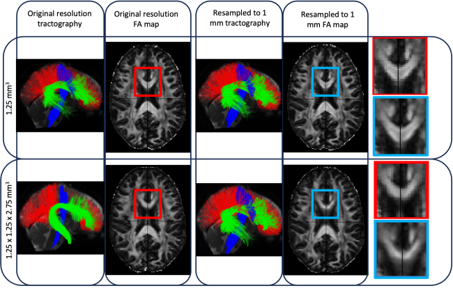 Sensitivity of Quantitative Diffusion MRI Tractography and ...