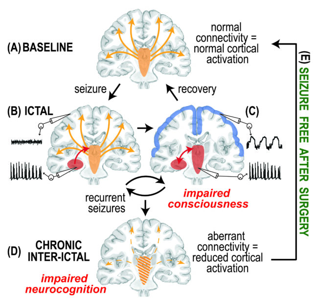 Relating vigilance to connectivity and neurocognition in temporal lobe epilepsy | Vanderbilt ...