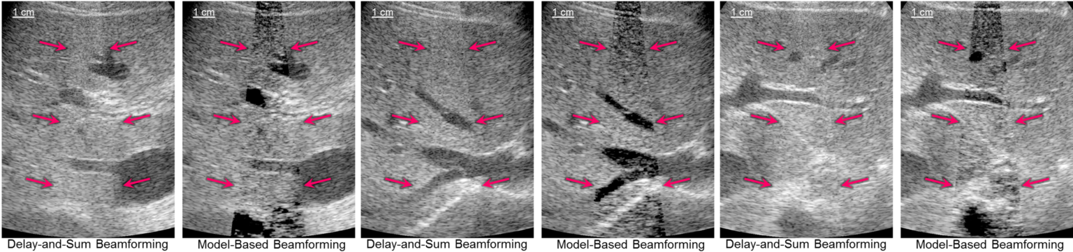 Suppression and analysis of ultrasonic clutter during liver focal ...