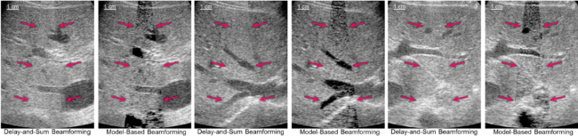Suppression and analysis of ultrasonic clutter during liver focal ...