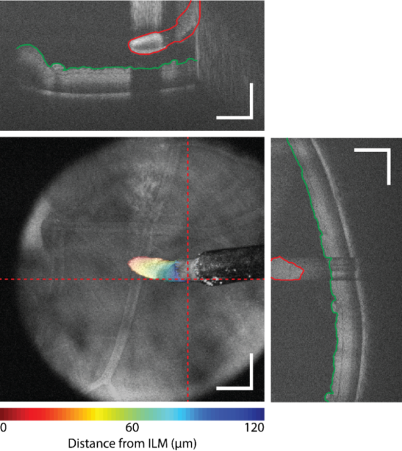 Intraoperative imaging of macular hole repair to predict visual ...