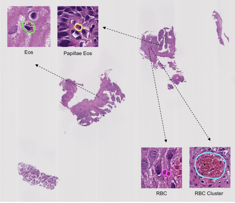 Eosinophils Instance Object Segmentation on Whole Slide Imaging Using ...