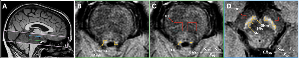 Central Involvement in Pure Autonomic Failure: Insights from ...