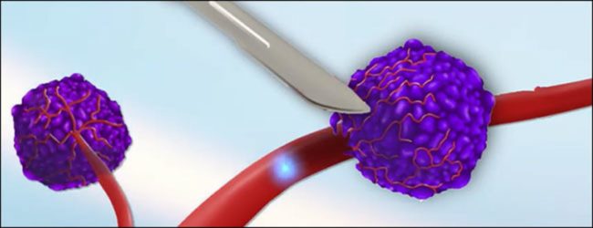 Cellular soldiers designed to kill cancer cells that get loose during ...