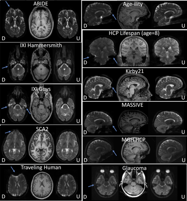 Distortion Correction Of Diffusion Weighted Mri Without Reverse Phase