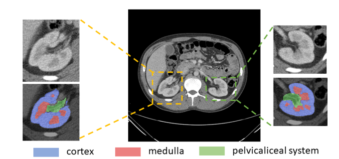 Renal Cortex, Medulla and Pelvicaliceal System Segmentation on Arterial Phase CT Images with ...