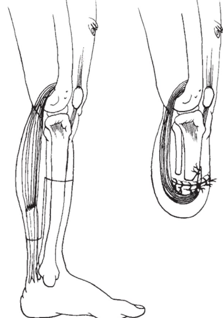 Update #1 | Postoperative Edema Monitoring and Control | Vanderbilt ...