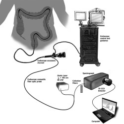 Detecting inflammatory bowel disease during a colonoscopy | Vanderbilt ...
