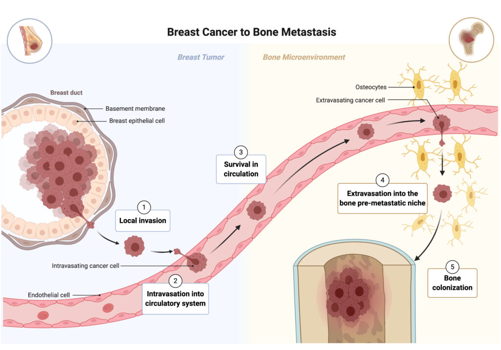 Breast Cancer Metastasis to the Bone Microenvironment | Young Scientist Journal | Vanderbilt ...