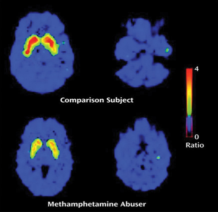 How Meth Impacts Brain Chemistry | Nurse News | Vanderbilt University